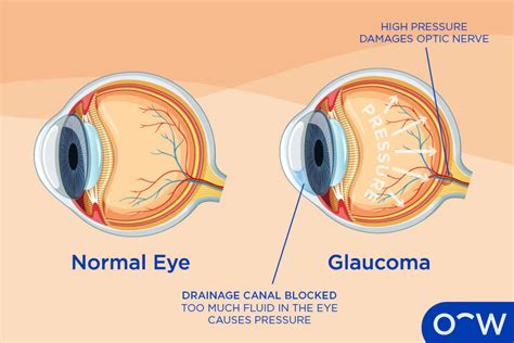 Eye Doctors Understanding The Difference Between Optometrists
