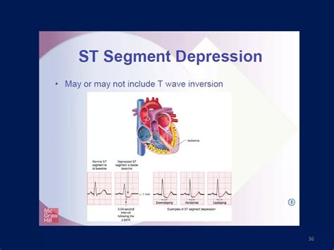 Ekg Myocardial Ischemia And Infarction Ppt