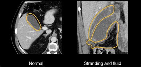 Abdominal Ct Cholecystitis • Litfl • Radiology Library