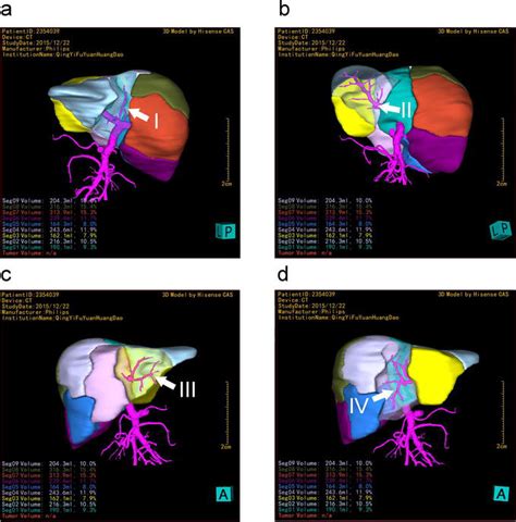 A New Liver Segmentation Based On Digital Liver Portal Vein Ramification Using Computer Assisted