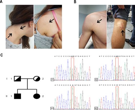 A Novel Abcc6 Variant Causative Of Pseudoxanthoma Elasticum Human Genome Variation
