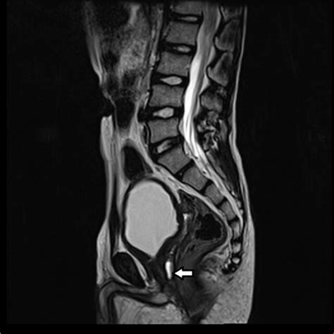 T2 Weighted Sagittal Section Of The Pelvis Shows The Prostatic Utricle