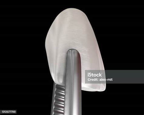 중앙 절개 위에 베니어 설치 절차 의학적으로 정확한 치아 3d 일러스트레이션 건강관리와 의술에 대한 스톡 사진 및 기타 이미지 건강관리와 의술 도예 디자인 Istock