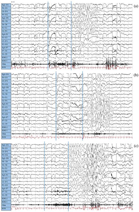 Self Induced Stretch Syncope An Unusual Non Epileptic Paroxysmal Event A Case Report And
