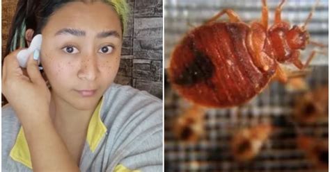 Joven Teme Por Su Vida Tras Ser Picada Por Una Chinche La Roncha Se Puso Negra Y Dura Infobae
