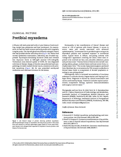 Pretibial Myxedema Pathology