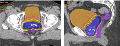 Isodose Plot For The Anatomy Based Vmat Plan For A Specific Prostate