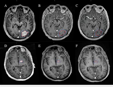 Representative Axial T1 Post Contrast Mri Images Demonstrating Target