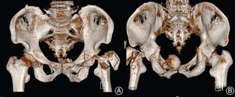 Three‐dimensional Reconstruction Of Ct Showing Obturator Dislocation Of