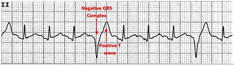 What Do Multifocal Pvcs Indicate