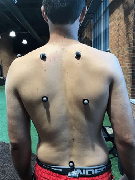 Resting Scapular Position With Marker Placement Download Scientific Diagram