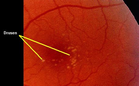 What Is A Retinal Drusen Dry Macular Degeneration Cgnpeb