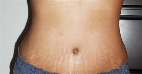 What Do Stretch Marks Look Like After Weight Loss
