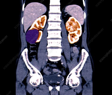 Renal Cancer Ct Scan Stock Image C047 4236 Science Photo Library