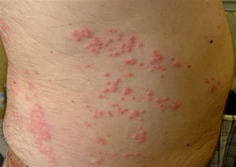 Pruritus Central Wyoming Skin Clinic