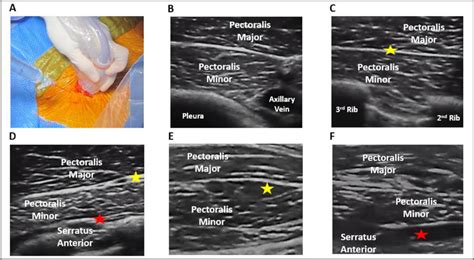 Intraoperative Pectoral Nerve Pecs Block At The Time Of Cardiac Download Scientific Diagram
