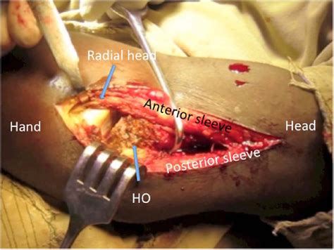 Photograph Of Lateral Exposure Of Radial Head Capitellum With