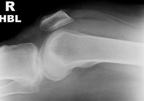 Lateral Knee Xray