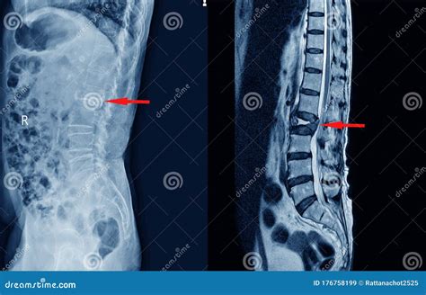 Bulging Disk Xray Maininstant