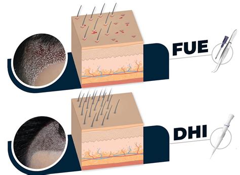 Whats The Difference Dhi And Fue