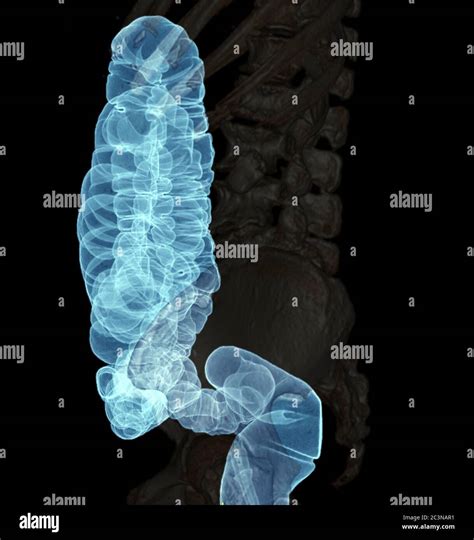 Ct Colonography Or Ct Scan Of Colon 3d Rendering Image Lateral View