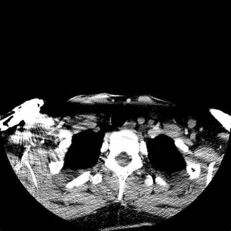 Ct Neck Bone Skull Head And Neck Cts