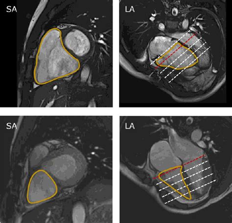 Figure From Deep Learning Segmentation Of The Right Ventricle In Cardiac MRI The M Ms