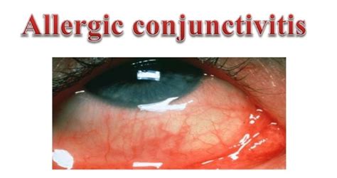 Allergic Conjunctivitis Causes Symptoms Treatment And Prevention