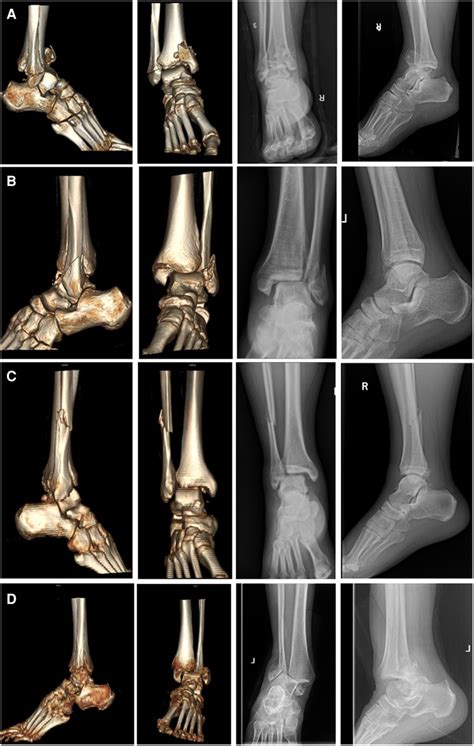 X Ray Ankle Dislocation Medworldonline