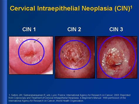 Pre Cancerous Cervical Lesions Gcdj