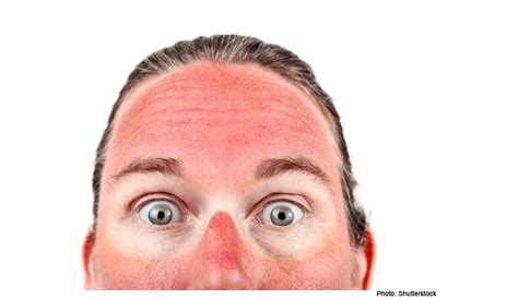 Top 6 Most Embarrassing Yet Common Tan Lines