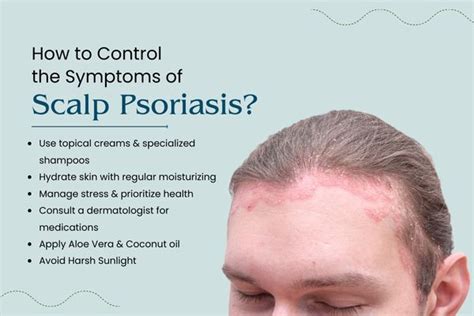 All About Scalp Psoriasis Causes Triggers Symptoms And Treatment