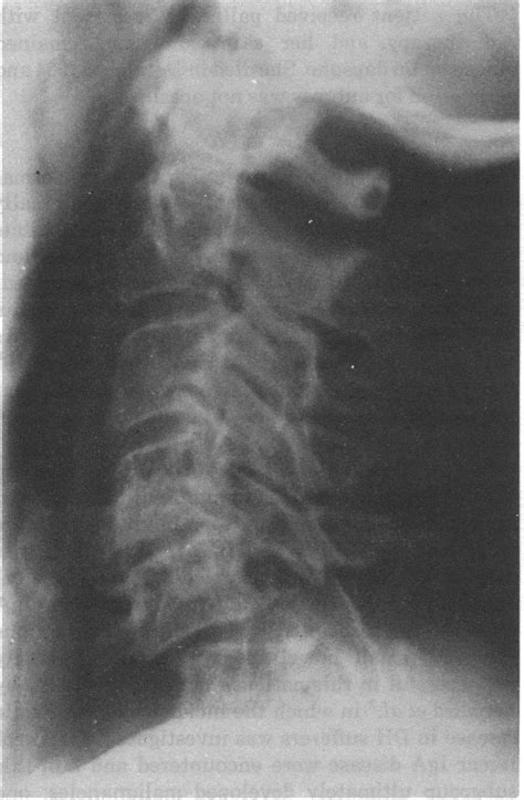 Later X Ray Showing Anterior Subluxation Of C5 On C6 Download