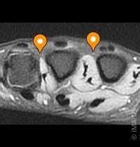 Dorsal Metacarpal Arteries E Anatomy Imaios