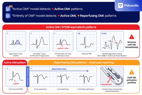 Advanced Stemi Detection And Improved Cath Lab Activation Through