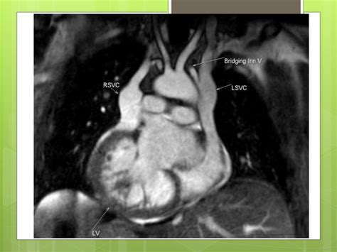 Coronary Sinus Anatomy Pptx