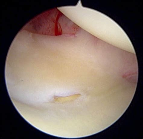 Triangular Fibrocartilage Complex And Ligamentary Injuries Correlation Between Mri And Wrist