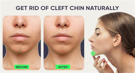 What Causes A Cleft Chin According To Science Ach