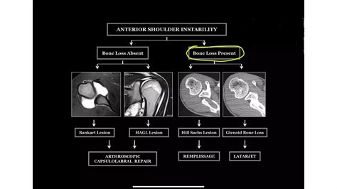 Shoulder Instability Pptx Death Injury Or Military Conflict Sensitive Topics
