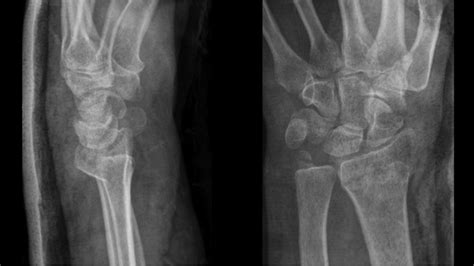 Surgical Anatomy Of The Distal Radius Clinical Tree Surgical Anatomy Of The Distal Radius Clinical Tree