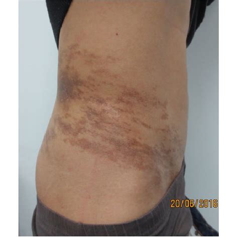 Case One Hyperpigmented Macules And Patches In A Blaschkoid Download Scientific Diagram