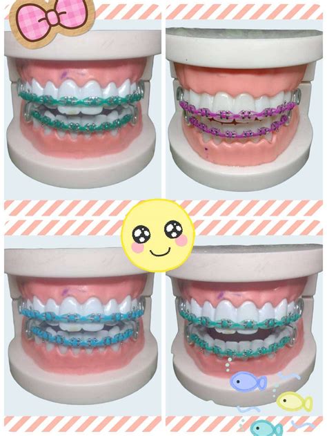 เครื่องประดับแฟชั่น เชนซ้อน รีเทนเนอร์ไร้เหงือก แฟชั่น ใส่ง่าย ถอดง่าย แพค1คู่ กันเจ็บฟรี พร้อม