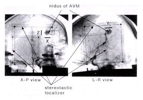Figure 1 From Stereotactic Radiosurgery Using A Linear Accelerator For The Treatment Of Cerebral