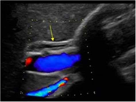 Abdomen And Retroperitoneum 12 Gallbladder And Bile Ducts Case 12