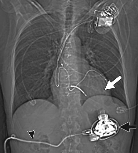 Ct Of Left Ventricular Assist Devices Radiographics