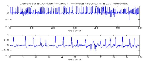 Denoised Mit Bih Ecg Record 203 Fig 4mit Bih Ecg Record 203 With