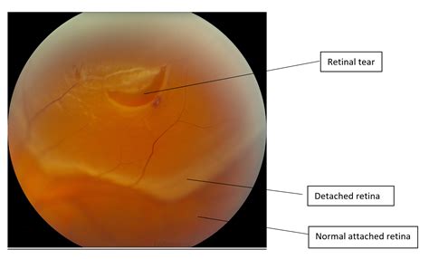 Retinal Detachment Retinal Tear Symptoms And Treatment Of Retinal My