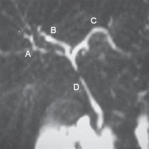 Mr Cholangiography Demonstrating A Normal Hepatic Anatomy A Right