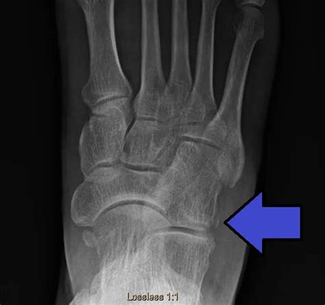 Cuboid Bone Anatomy Function Related Muscles