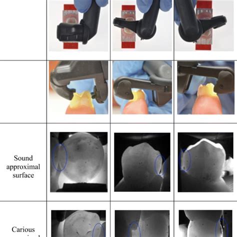 Digital Imaging Fiber Optic Transillumination Difoti Image